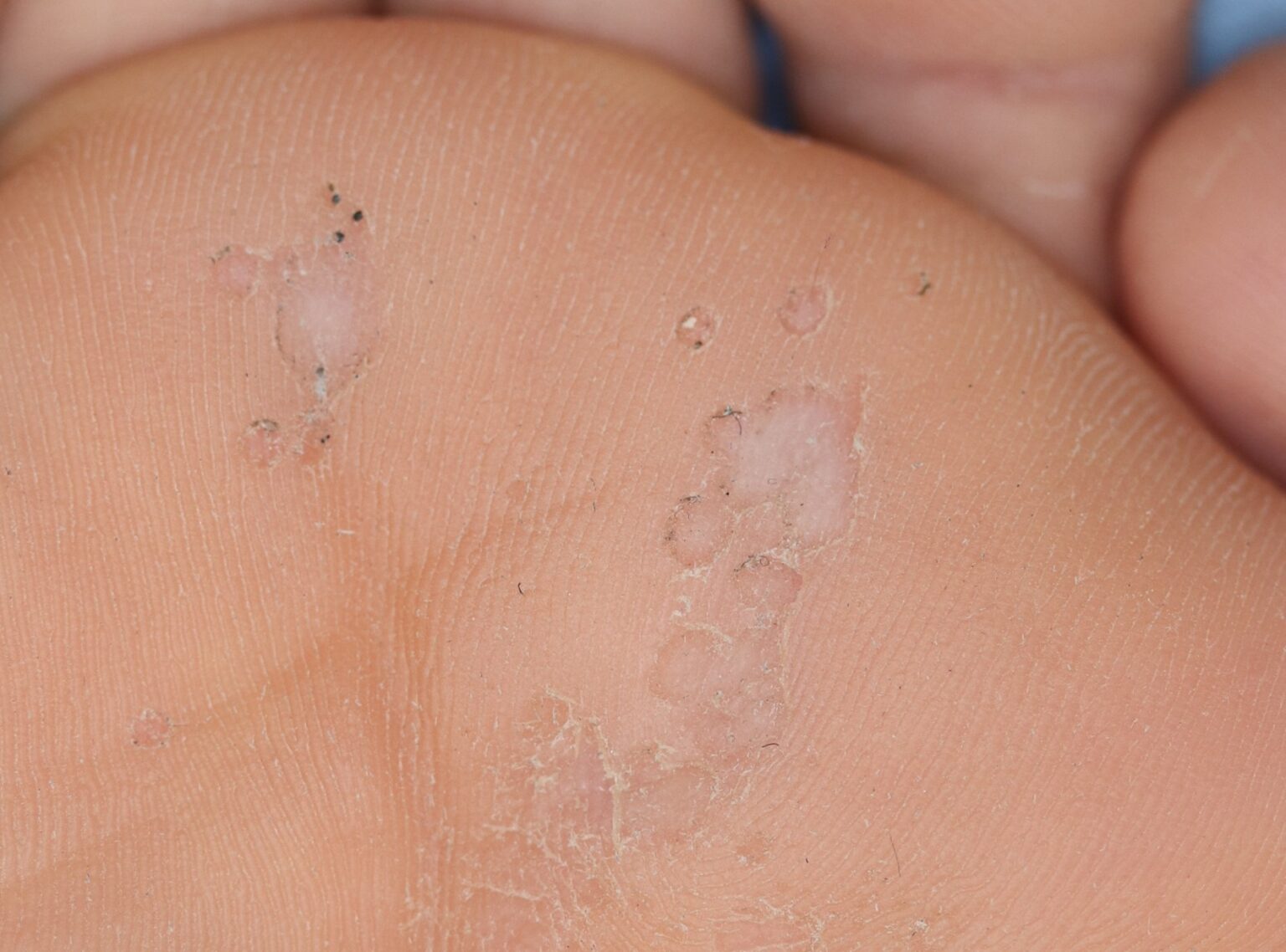 「pitted keratolysis（点状角質融解症）」について